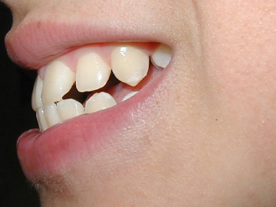 Invisalign Mesquite, TX | Clear Aligners | Riviera Family Dentistry